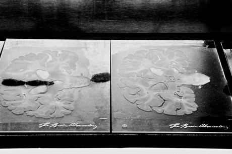 Henry Molaison Brain - Jacopo Annese Brain Study